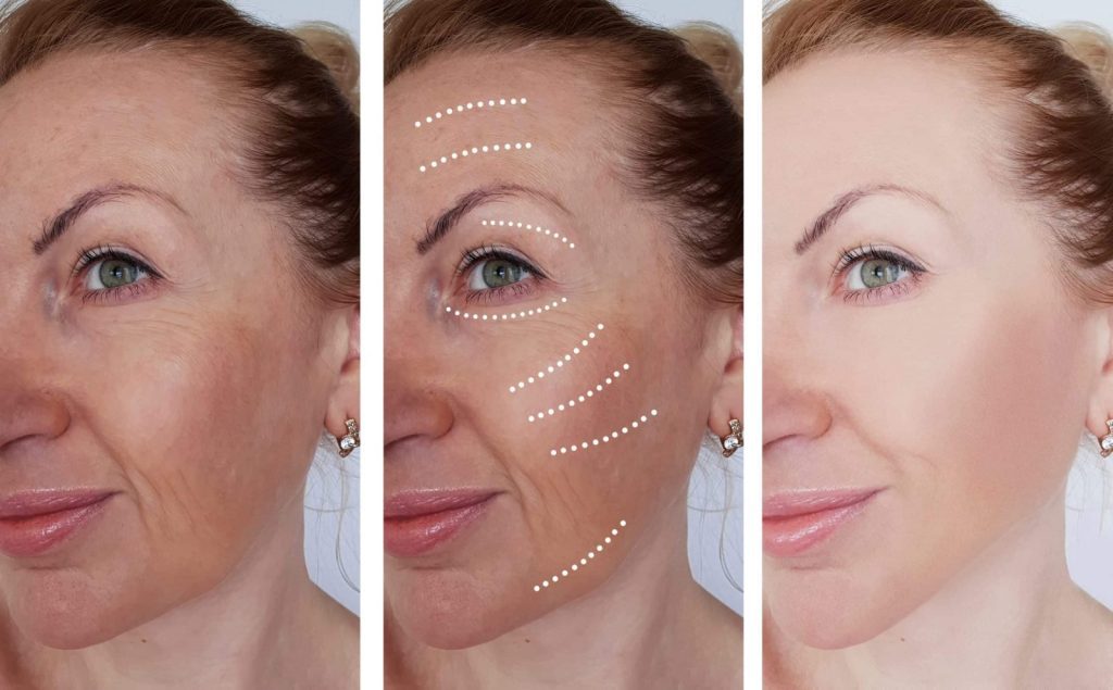 What Is A Non-Surgical Facelift? | Omniya