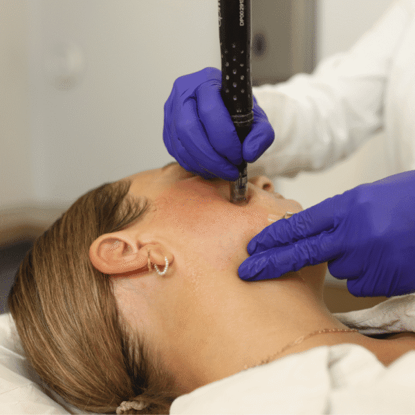 What Is A Skinpen Procedure? | Omniya