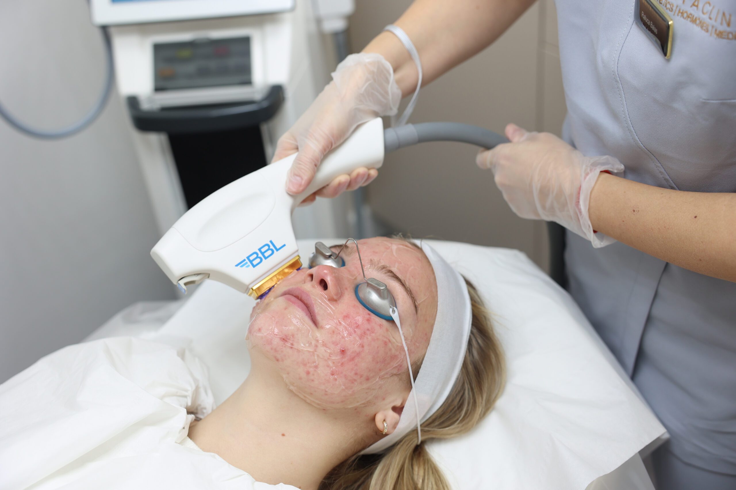Forever Clear BBL | Omniya Clinic London